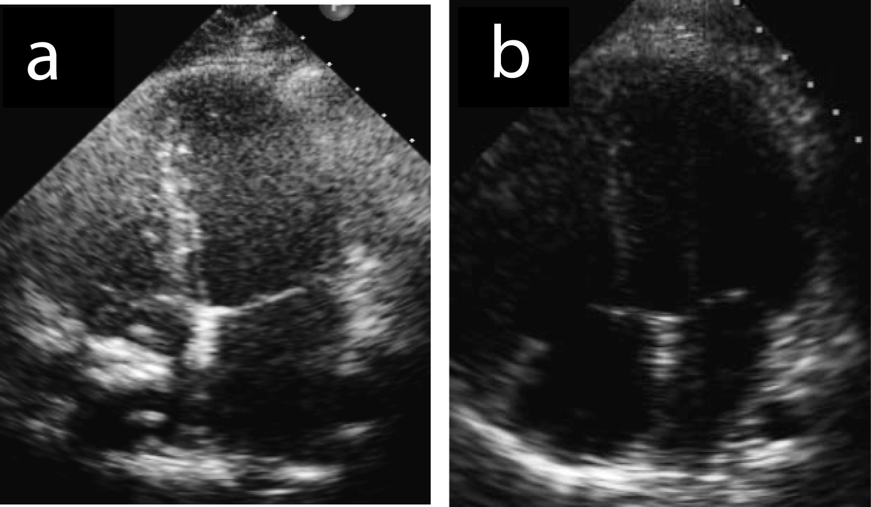 Calcified Thrombus in Right Atrium: Rare but Treatable Complication of ...